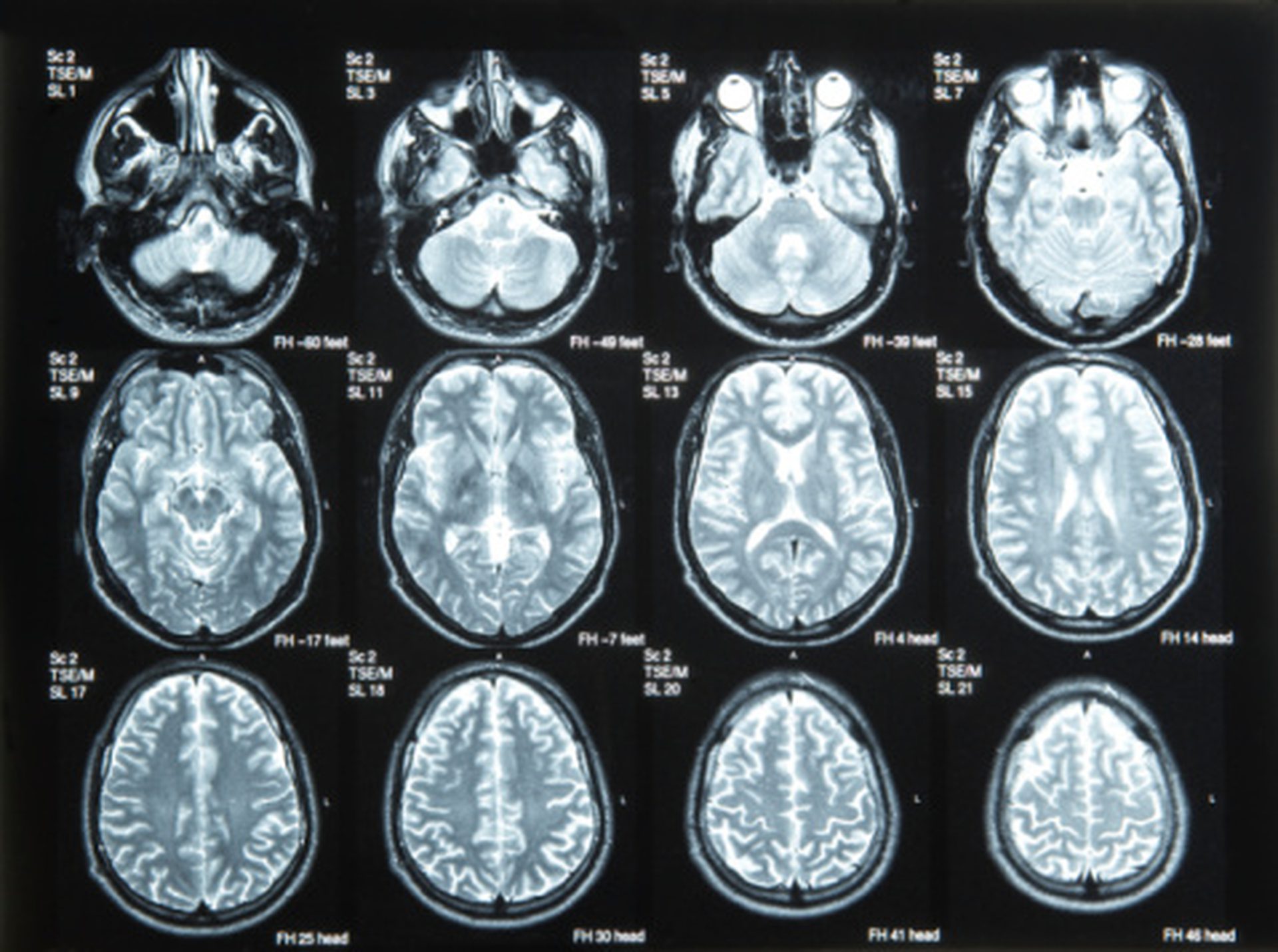 Taking Calcium Supplements Causes Brain Lesions - Pause For Thought